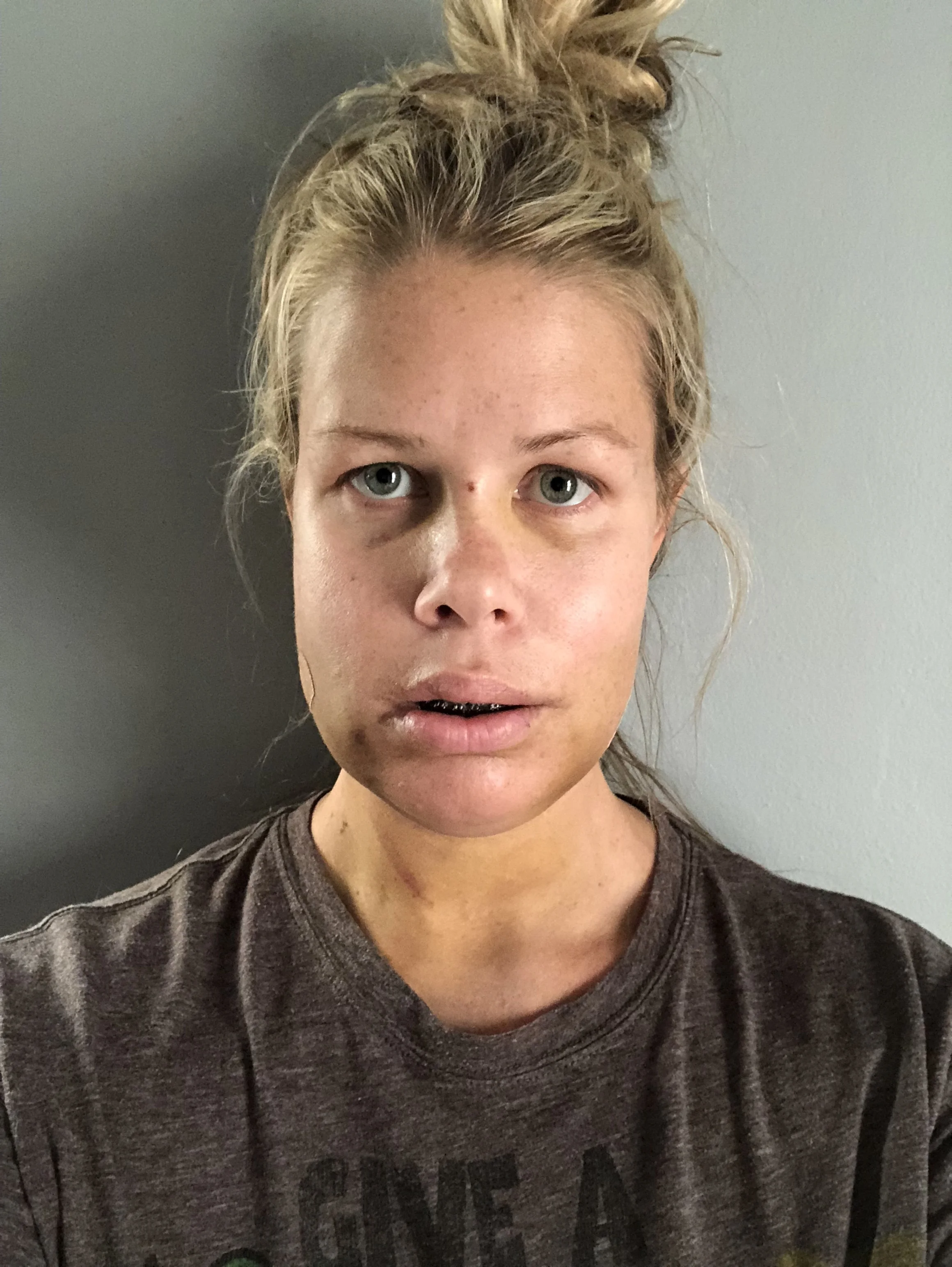 Underbite Surgery Swelling