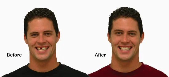 Dental Flipper Before And After