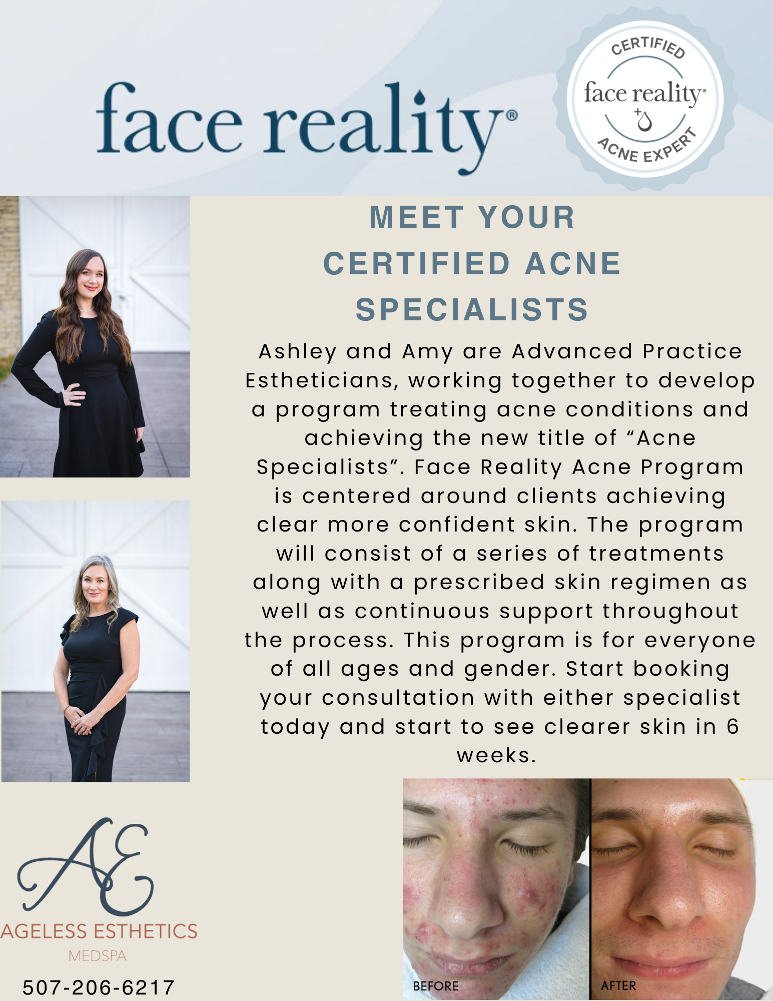 Face Reality Acne Program — Ageless Esthetics Medspa