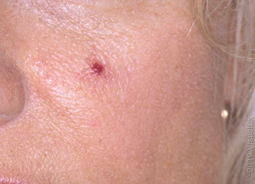5 LESIONES FACIALES HABITUALES EN LA CONSULTA DE DERMATOLOGÍA ¿LAS ...