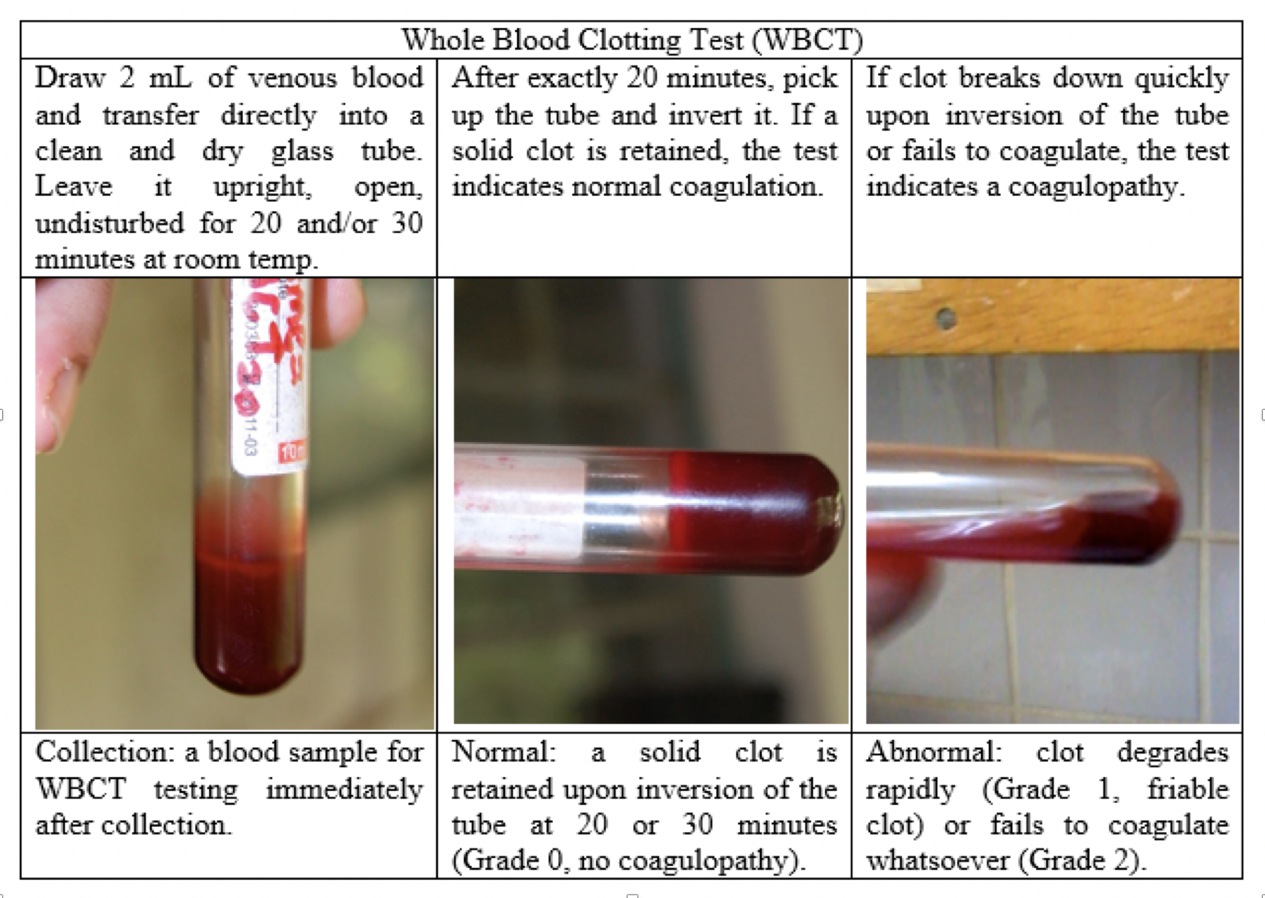 Whole Blood Clotting Test WBCT The Asclepius Snakebite Foundation