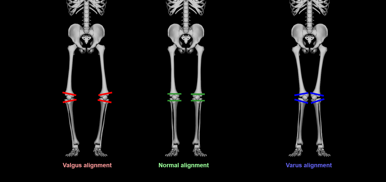 THE MOVING BODY - Walking Gait Analysis (Part II): Gait goals and ...