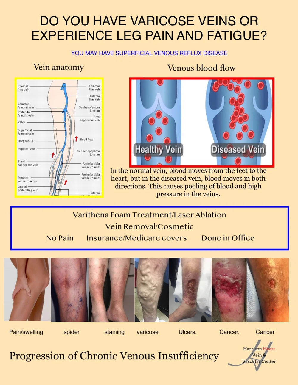 Lower Limb Venous Ablation