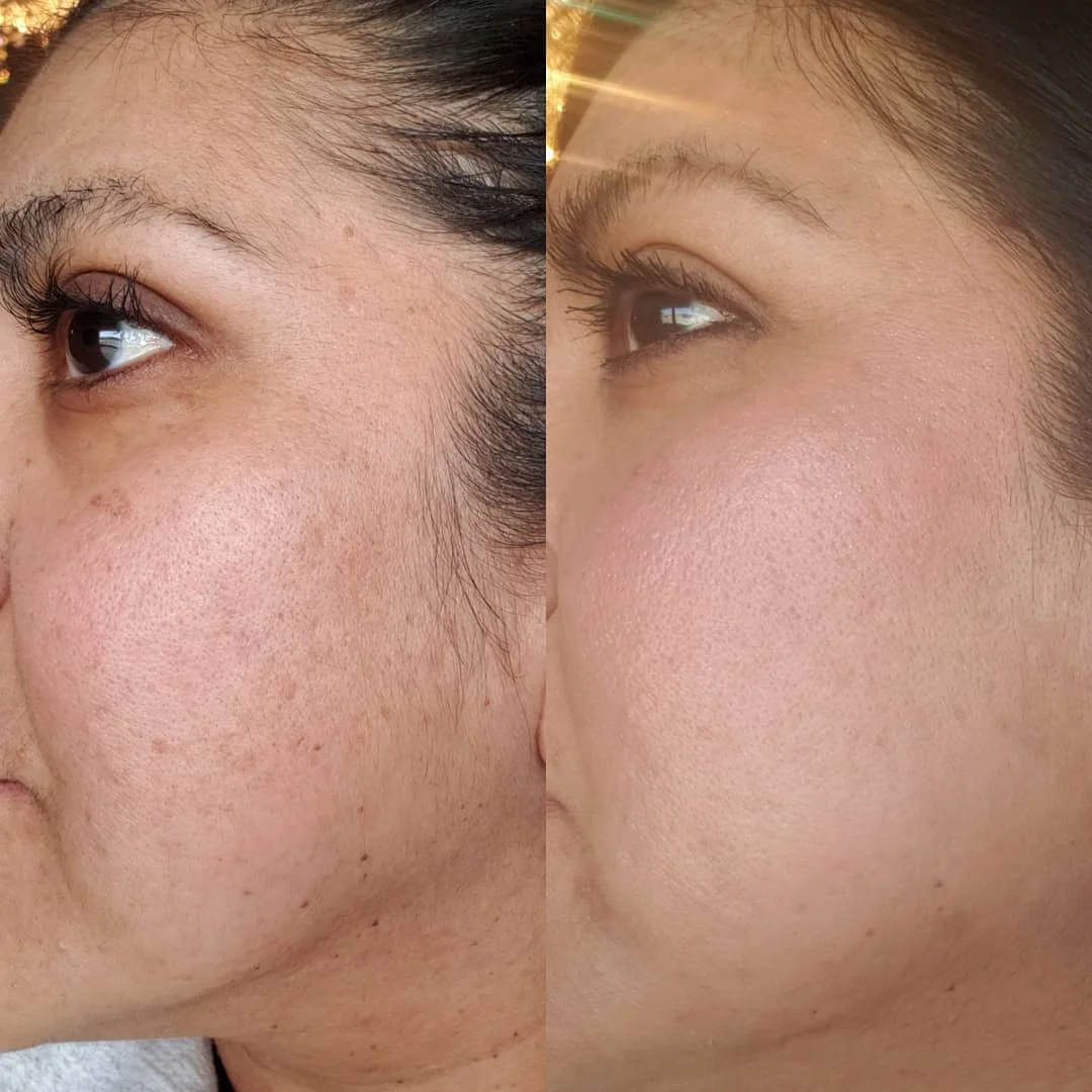 Erbium laser — glowlaserandbeauty.com