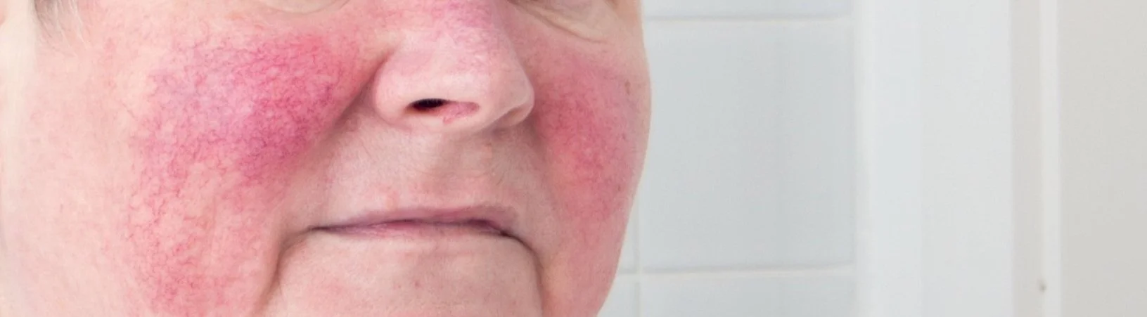 How to Treat Rosacea — Winchester | The Secret Garden Skin Clinic