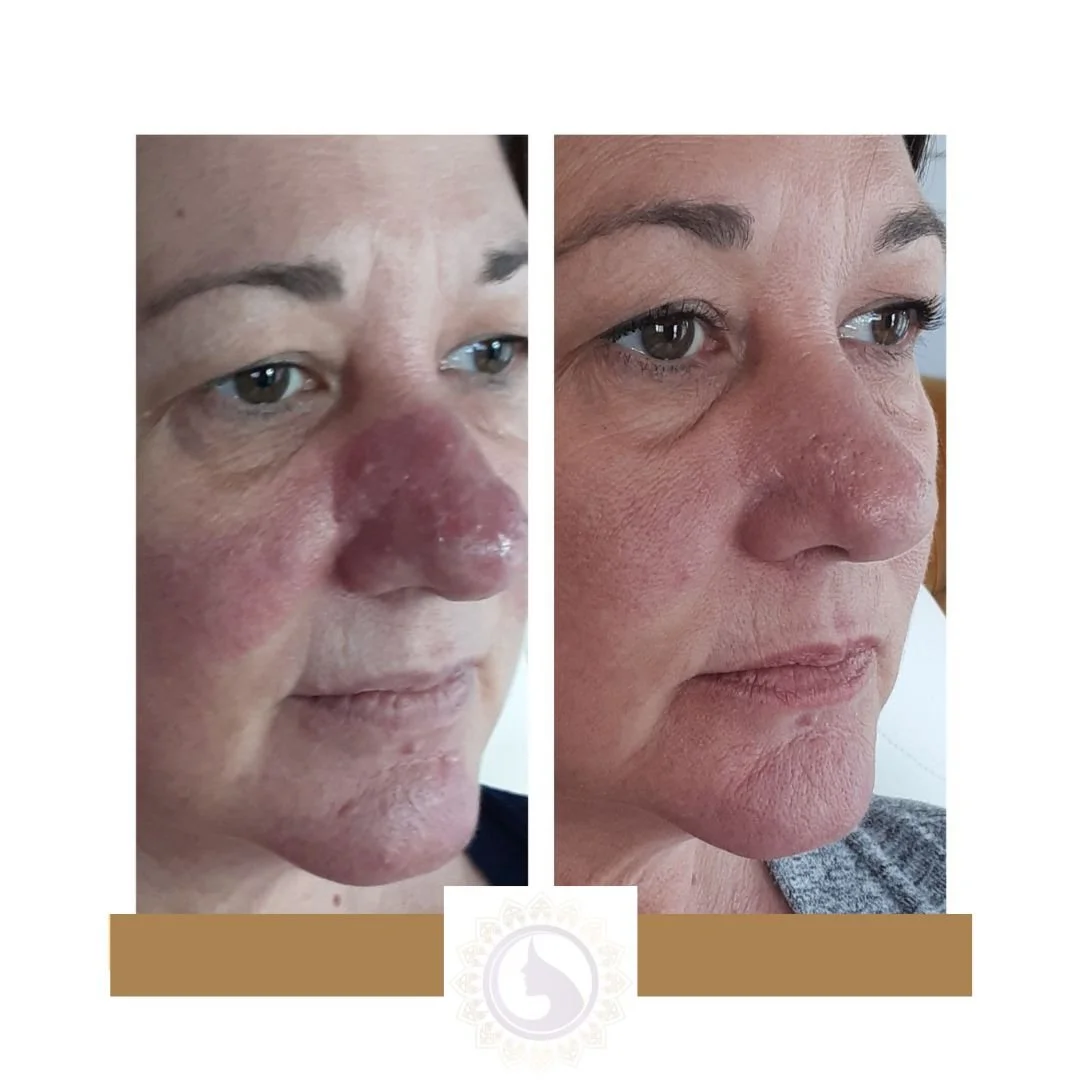 How to Treat Rosacea — Winchester | The Secret Garden Skin Clinic
