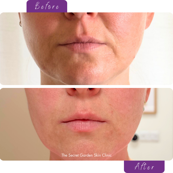 NeoGen Plasma Skincare Regeneration - Winchester | The Secret Garden ...