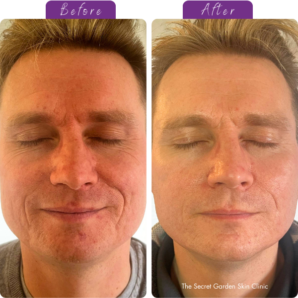 NeoGen Plasma Skincare Regeneration - Winchester | The Secret Garden ...