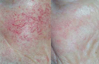 Laser Thread Vein Reduction — Winchester | The Secret Garden Skin Clinic