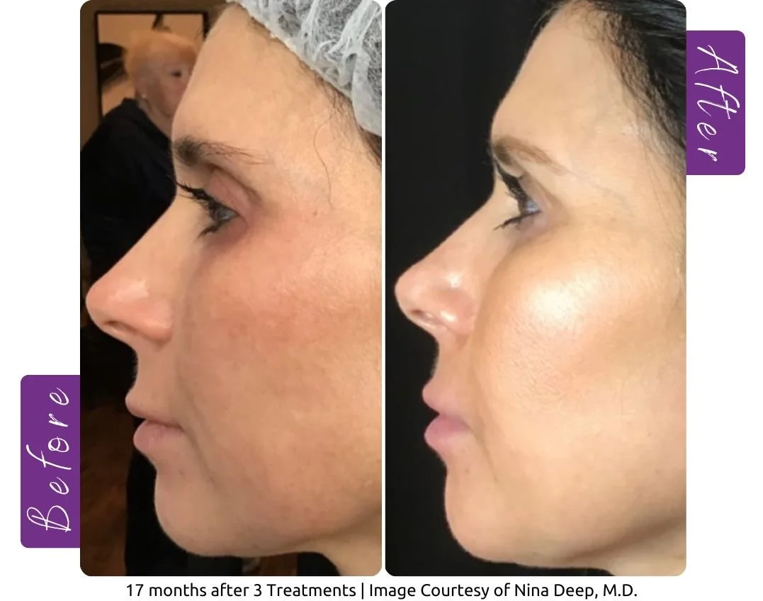 NeoGen Plasma Skincare Regeneration — Winchester | The Secret Garden ...