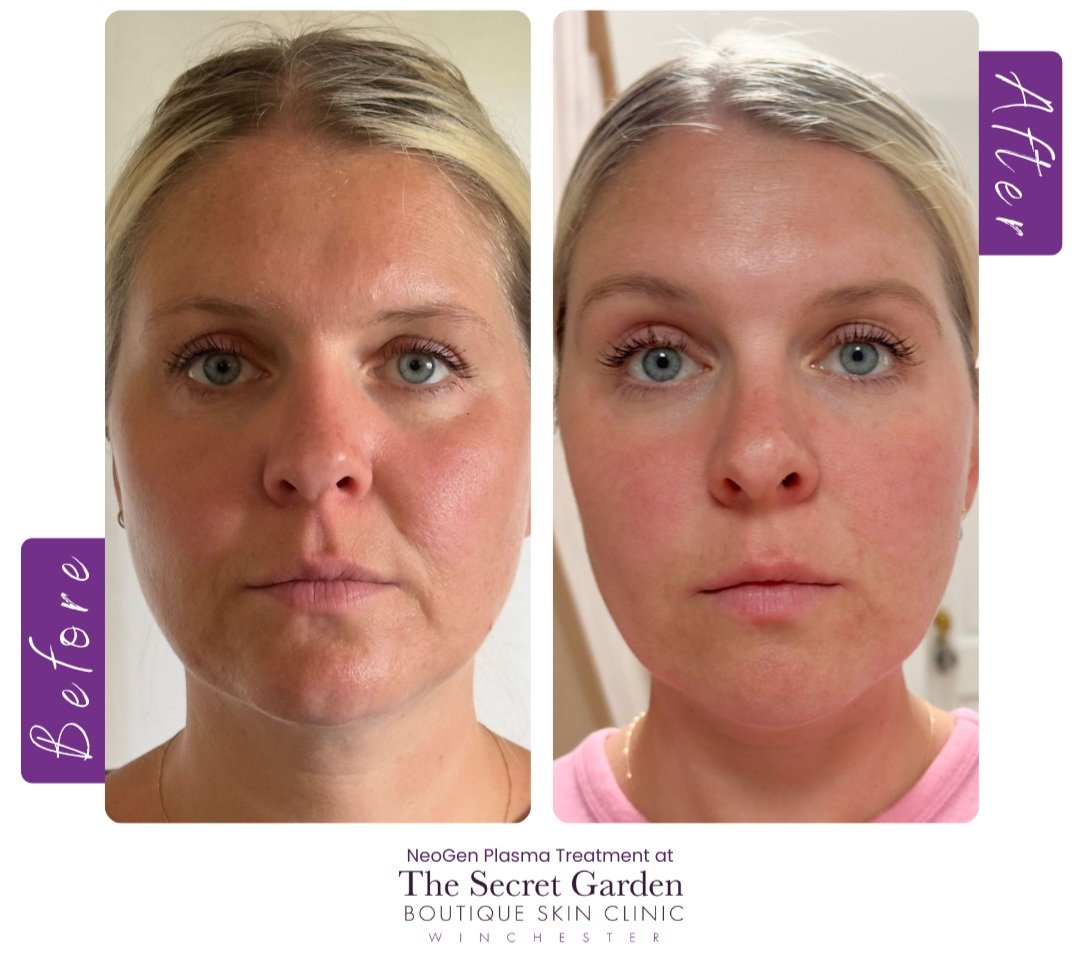 NeoGen Plasma Skincare Regeneration — Winchester | The Secret Garden ...