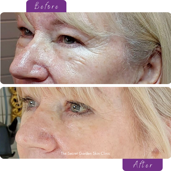 NeoGen Plasma Skincare Regeneration - Winchester | The Secret Garden ...