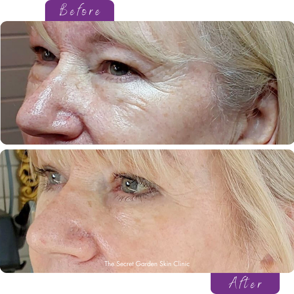 NeoGen Plasma Skincare Regeneration - Winchester | The Secret Garden ...