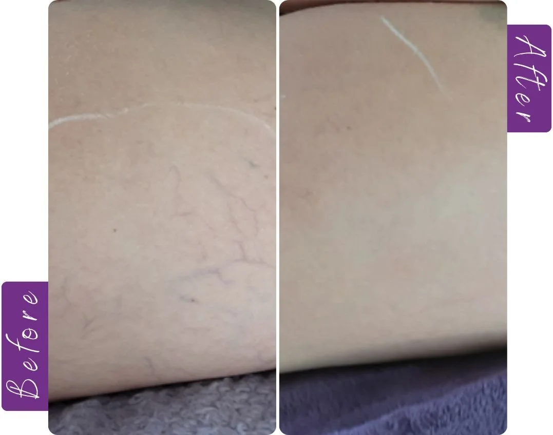 Laser Thread Vein Reduction - Winchester | The Secret Garden Skin Clinic