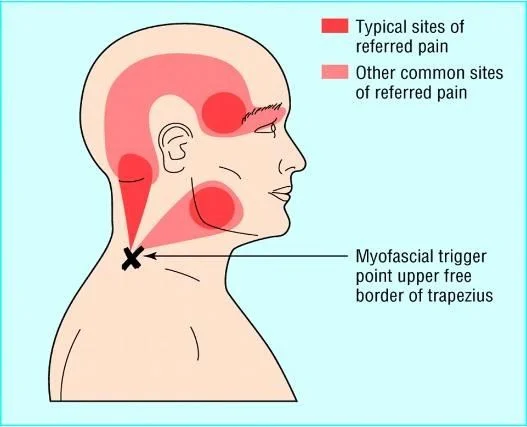 Craniomandibular Disorders (MPS) — Tui Na Massage Therapy and Head Pain ...