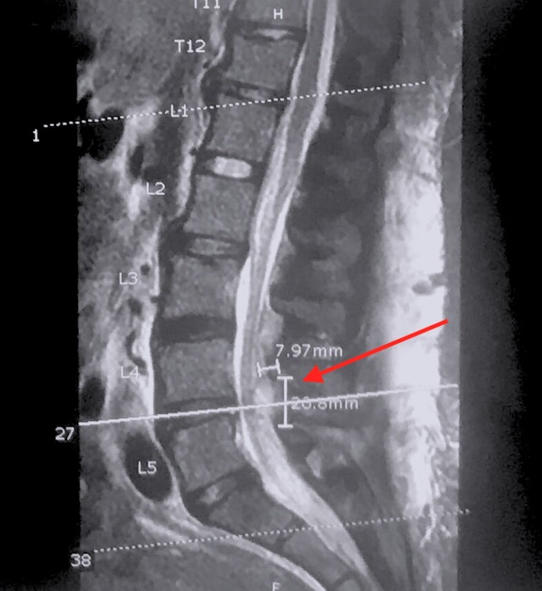 Lumbar Epidural Abscess — Institute of Neuro Innovation