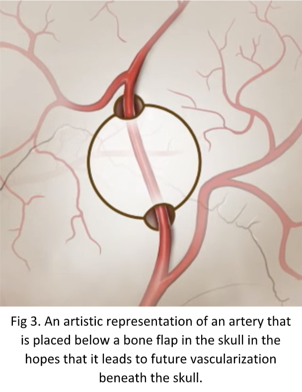 Moyamoya Disease — Institute of Neuro Innovation
