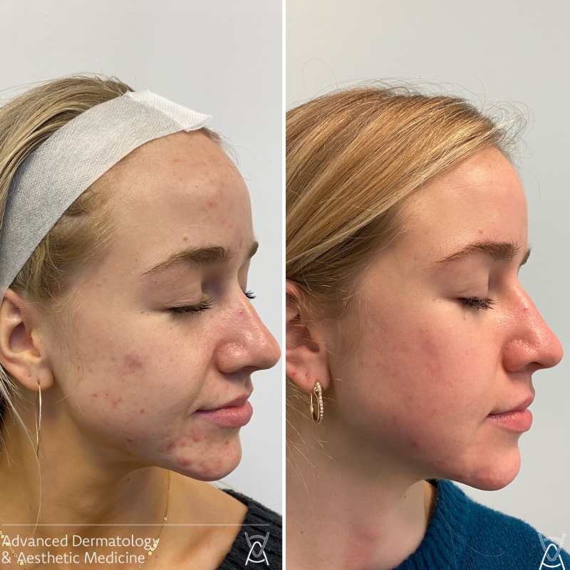 Before and After — Advanced Dermatology & Aesthetic Medicine