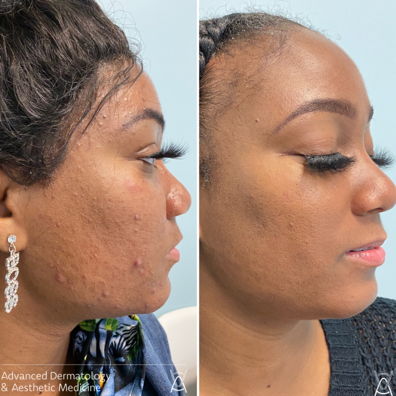Before and After — Advanced Dermatology & Aesthetic Medicine