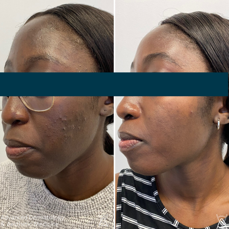 Before and After — Advanced Dermatology & Aesthetic Medicine