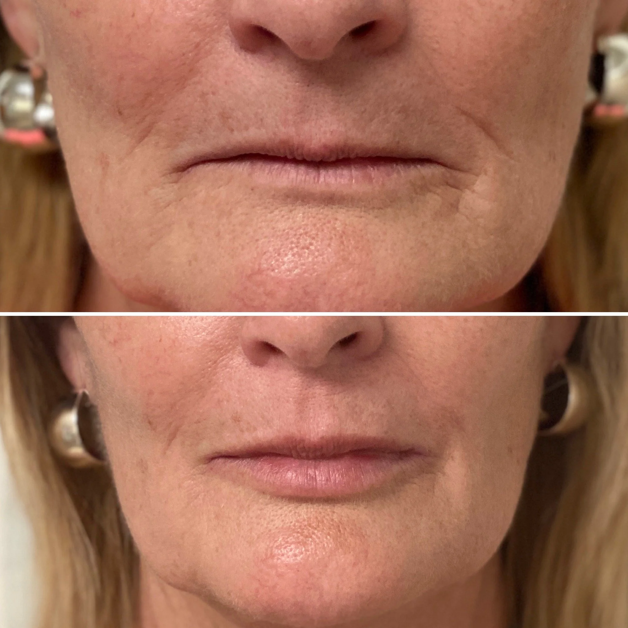 Dermal Fillers Chicago | Juvederm & Restylane Injections