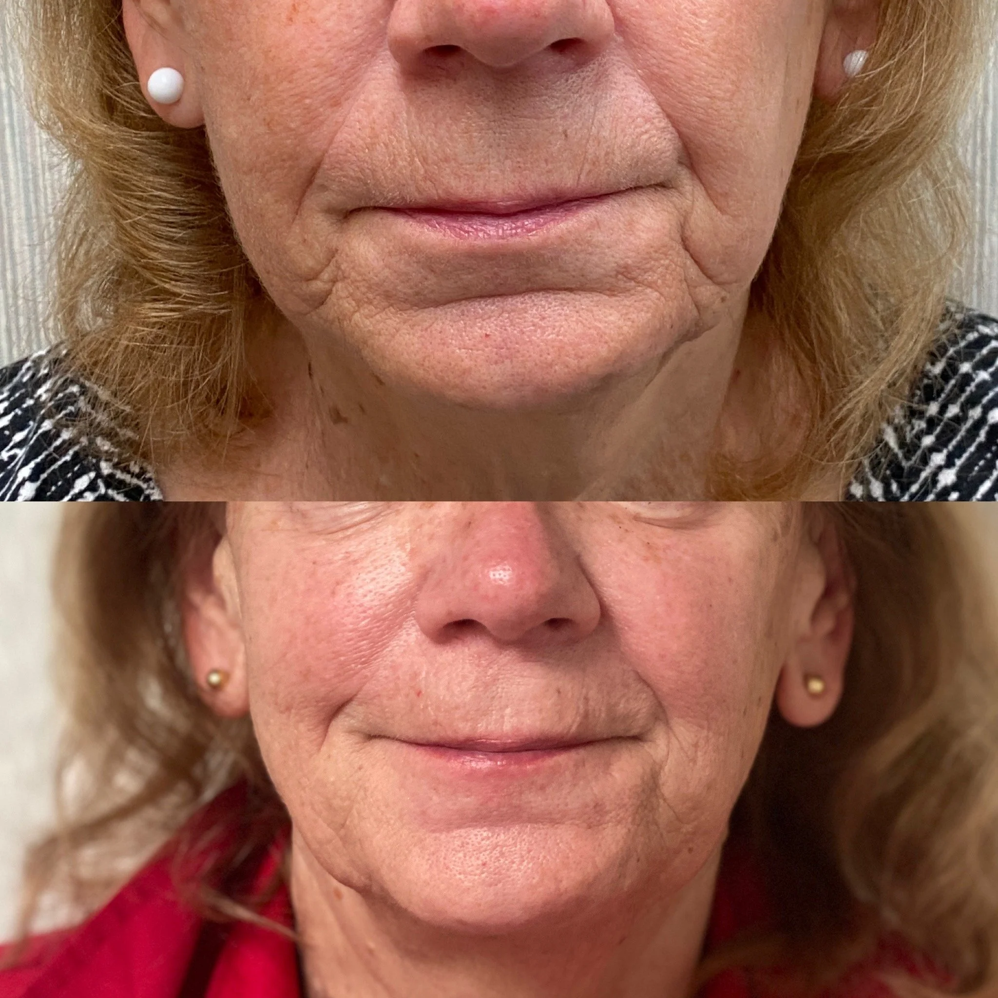Dermal Fillers — Advanced Dermatology & Aesthetic Medicine Dermal Fillers — Advanced Dermatology & Aesthetic Medicine