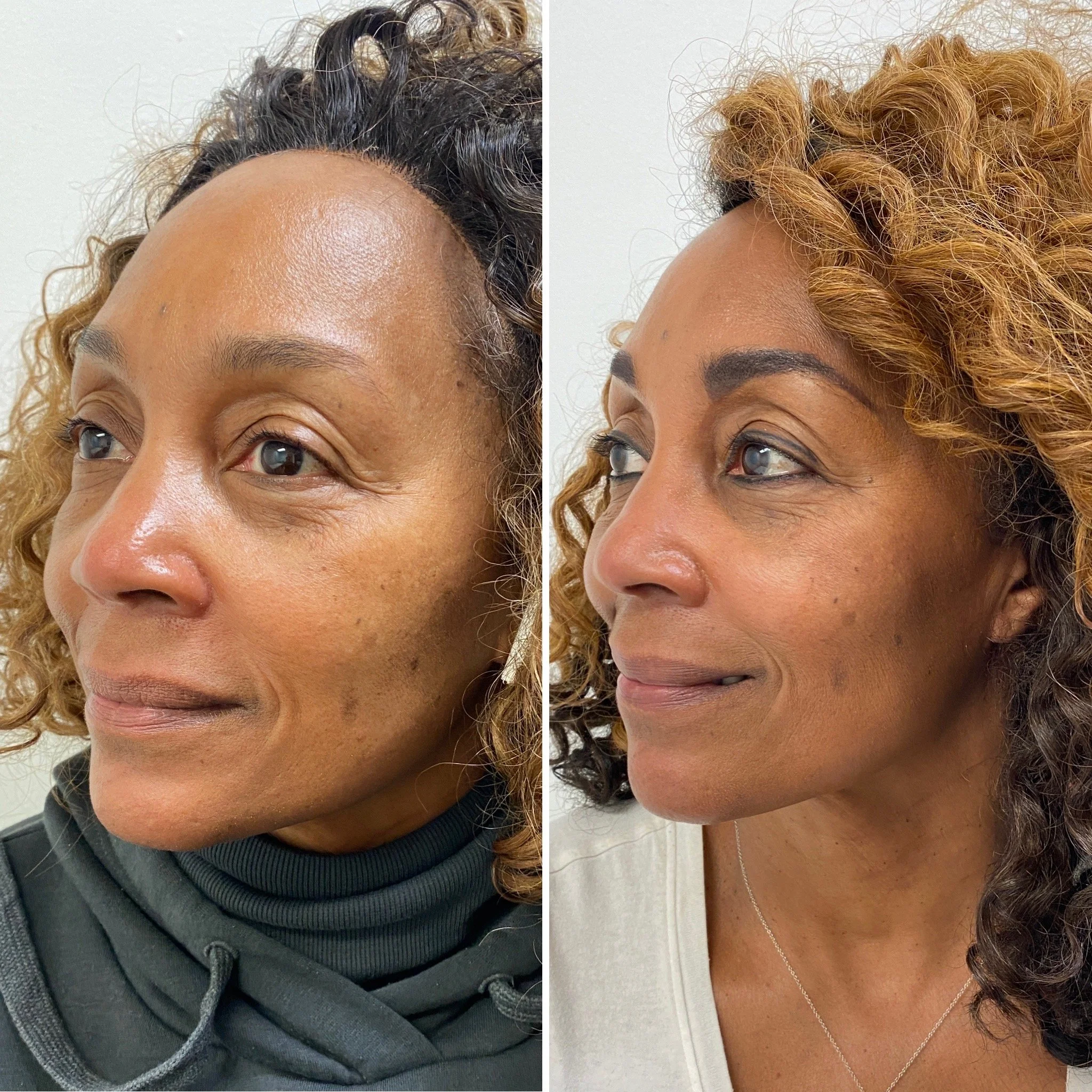 Dermal Fillers Chicago | Juvederm & Restylane Injections