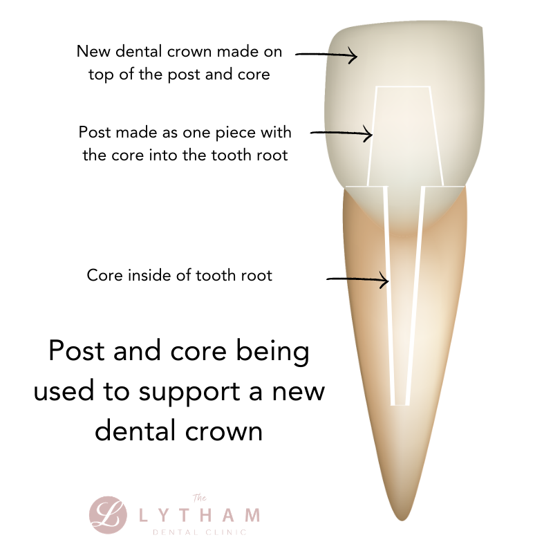 Dental Crowns - The Lytham Dental Clinic