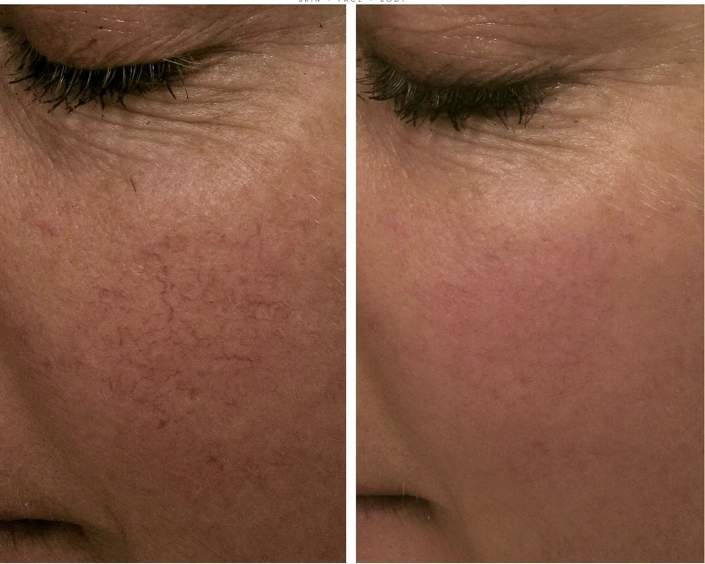 Red Vein + Skin Tag Removal — La Belle Peau Skincare Clinic