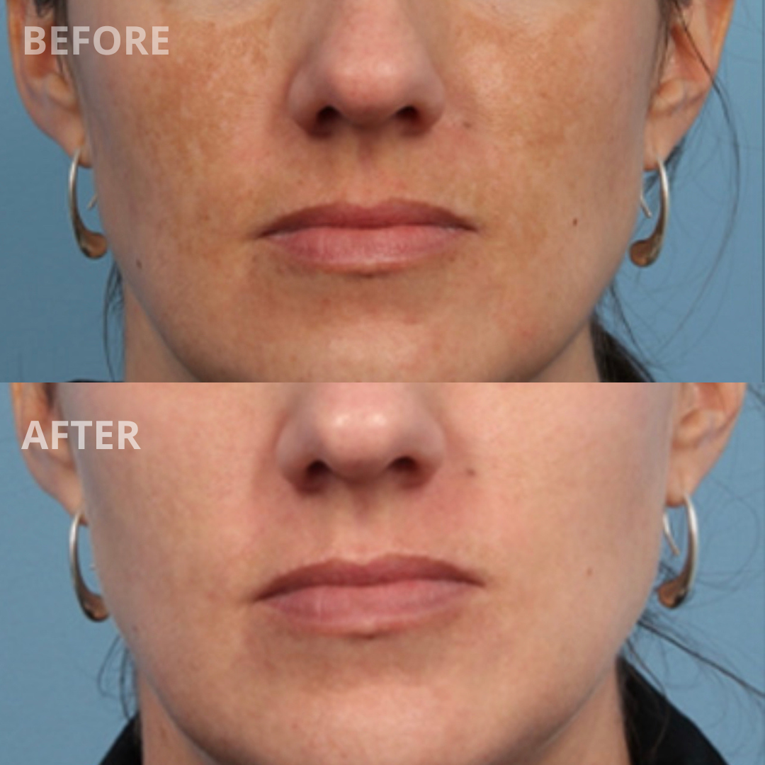 Hollywood Spectra Laser — La Belle Peau Skincare Clinic