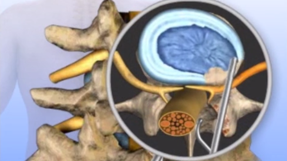 Disc Herniation | Aptiva Health