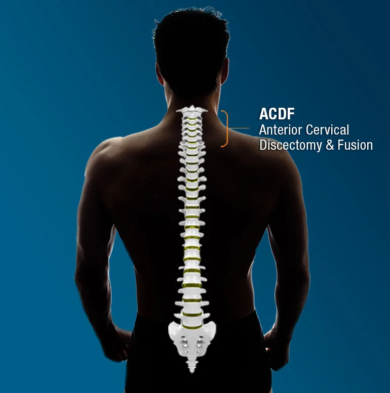 Anterior Cervical Discectomy - ACDF | Aptiva Health