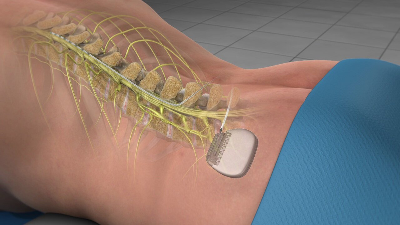 Spinal Cord Stimulator & Pain Pump | Aptiva Health