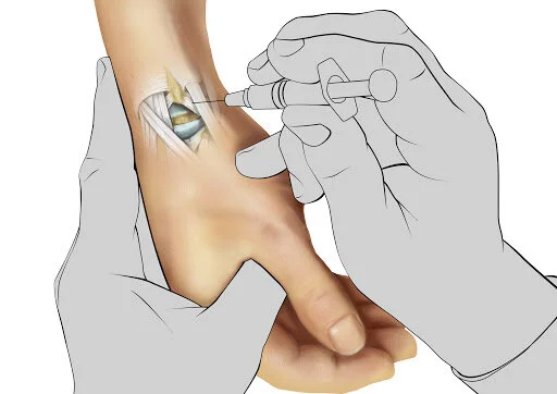 Wrist Injuries Treatment | Aptiva Health