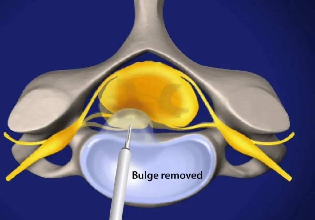 Lumbar Discectomy | Aptiva Health