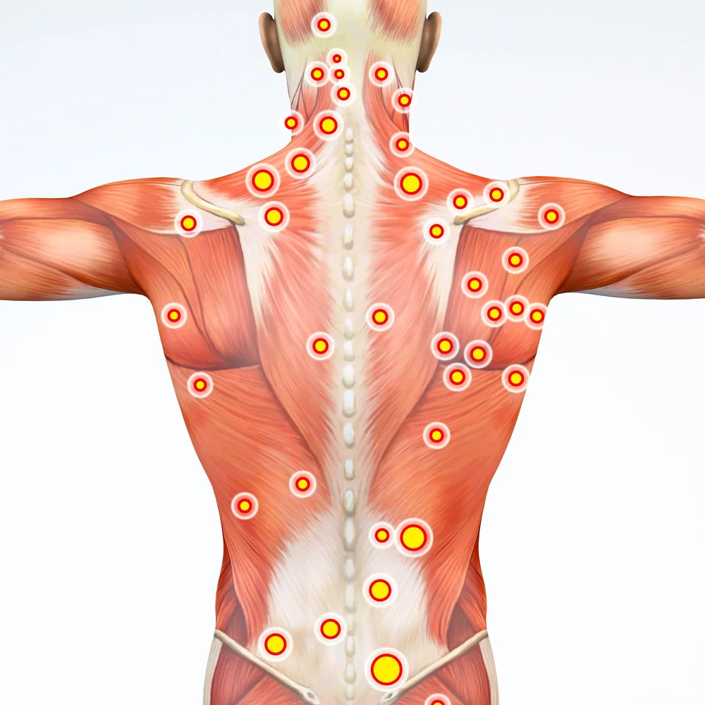 Dry Needling | Aptiva Health