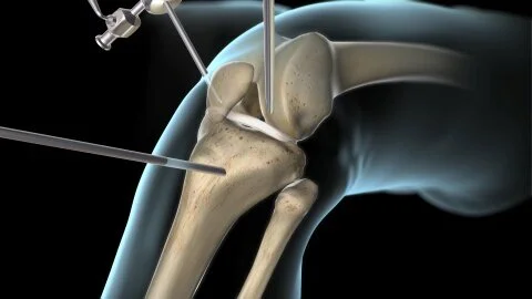ACL and MCL Treatment | Aptiva Health