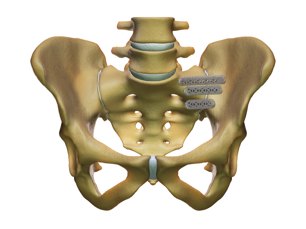 SI Joint Fusion | Aptiva Health
