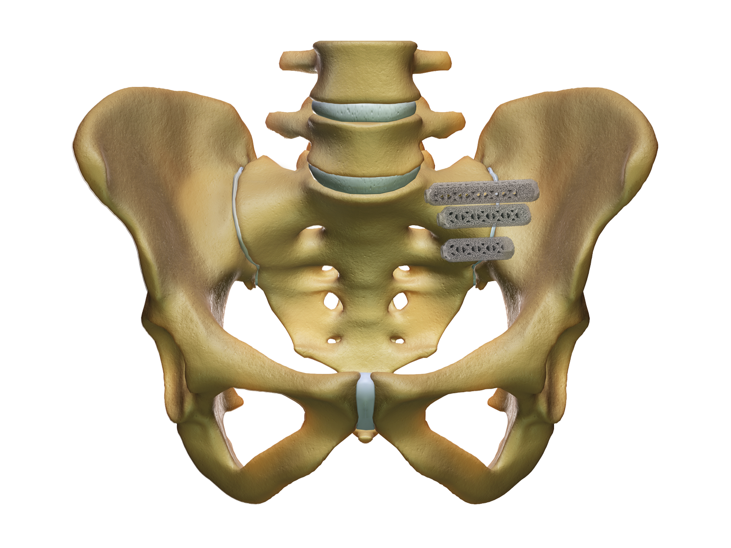 SI Joint Fusion | Aptiva Health