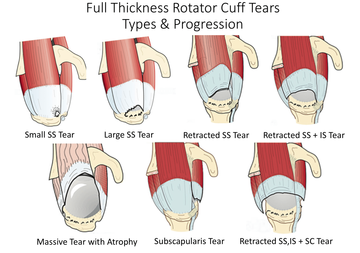 Rotator Cuff Repair | Aptiva Health