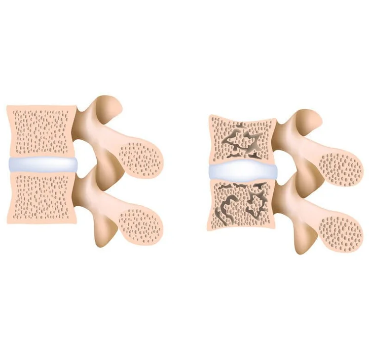 Kyphoplasty: Restore Spinal Health | Aptiva Health