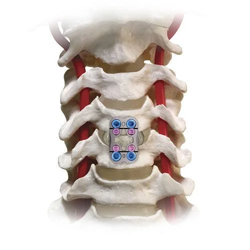 Anterior Cervical Discectomy - ACDF | Aptiva Health