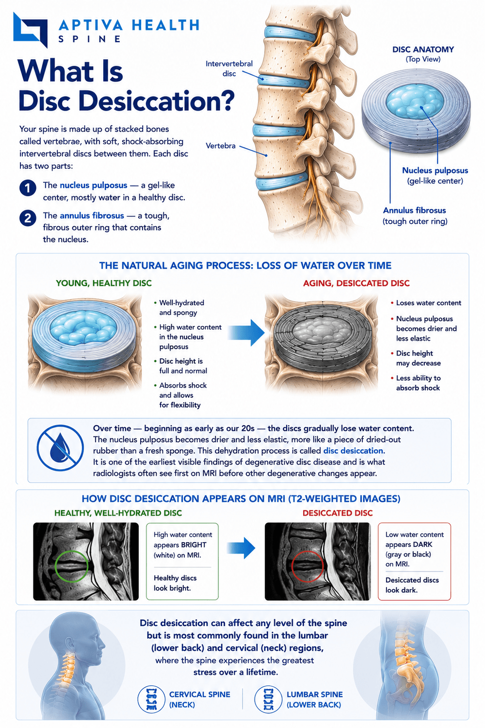 Disc Desiccation: Causes, Symptoms & Treatment | Aptiva Health