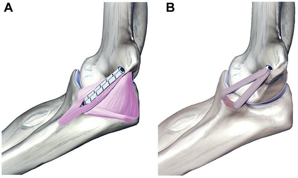 Elbow Surgery Post-Operative Instructions | Aptiva Health