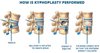 Kyphoplasty: Restore Spinal Health | Aptiva Health