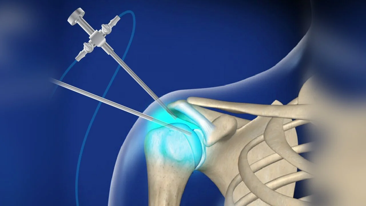 Shoulder Arthroscopy Post-Operative Instructions | Aptiva Health