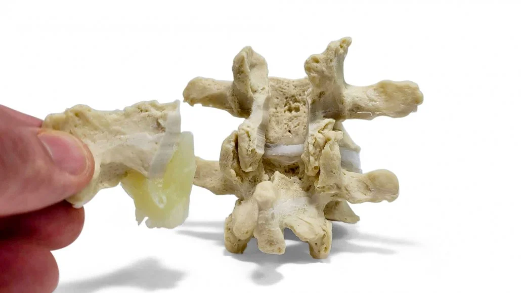 Laminectomy: Relief from Spinal Pain | Aptiva Health