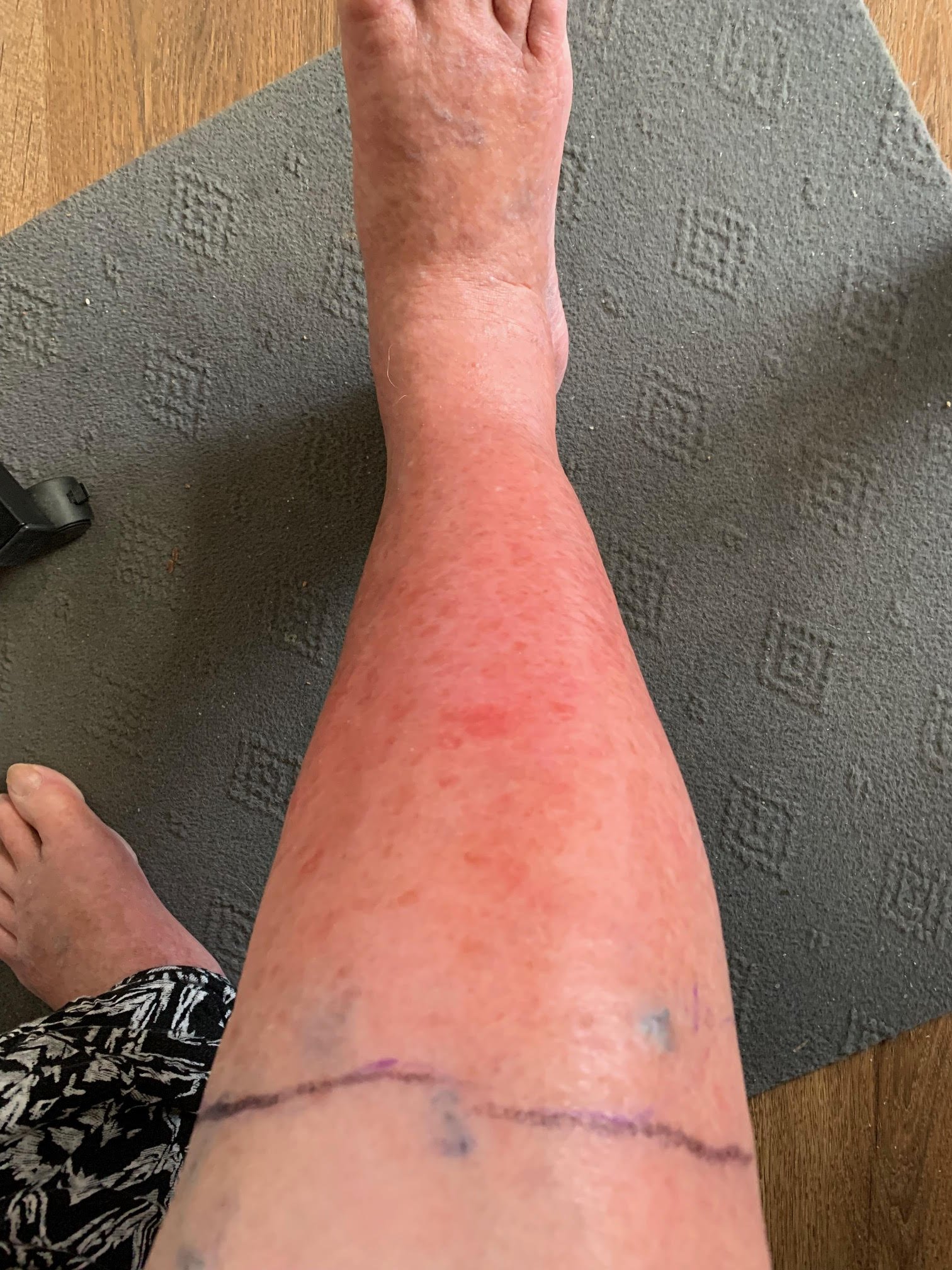 Cellulitis — Physio Living Newcastle NSW