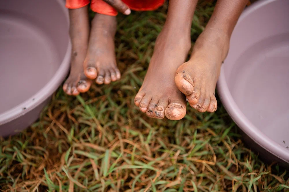 What Is A Jigger On The Foot Hot Sale | emergencydentistry.com