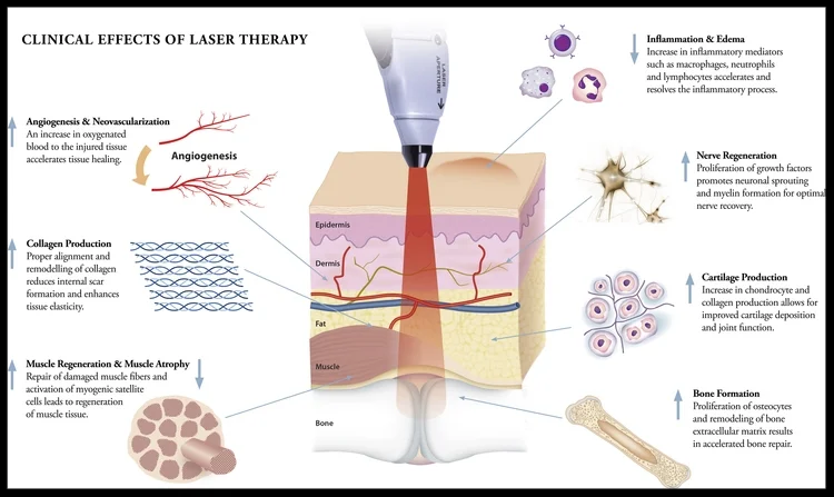 Laser Therapy — Renfrew Chiropractic & Rehabilitation Centre